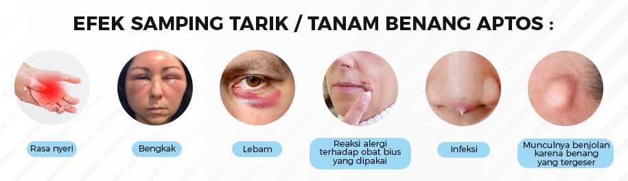 Tanam benang hidung Aptos dan ketahui efek sampingnya - Bumi Estetika